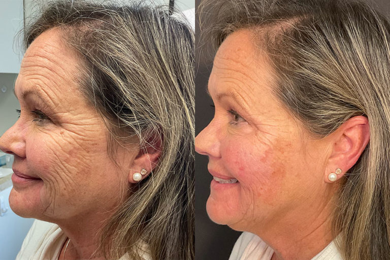 Hyperdilute Radiesse — What It Is and Why You'll Love It | Santa Barbara